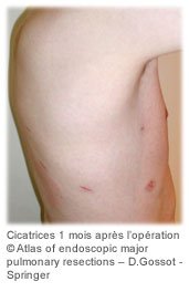 Chirurgie du cancer du poumon : segmentectomie, lobectomie ...