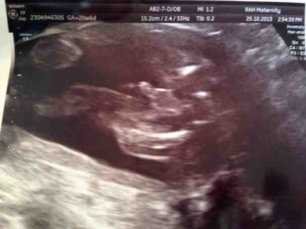 Boy bits on scan? Turned out to be a girl - Page: 2