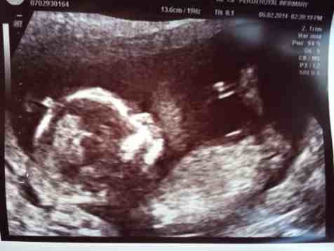 14 week scan photo- boy or girl?