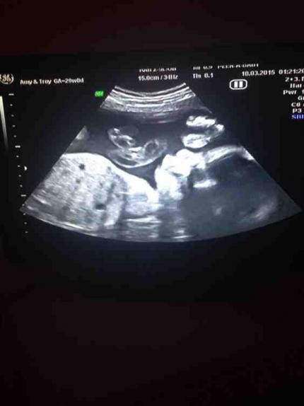 Is this hair on my baby's head? 4d scan