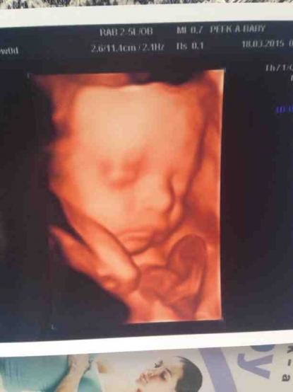 Is this hair on my baby's head? 4d scan