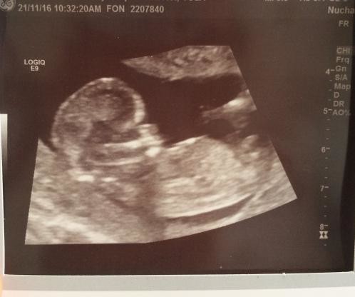 You can see his winky at 12 weeks scan?!