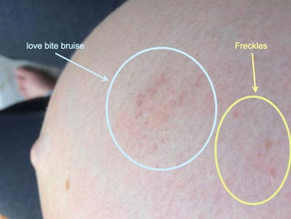 Sudden love-Bite bruise appeared on my baby bump??
