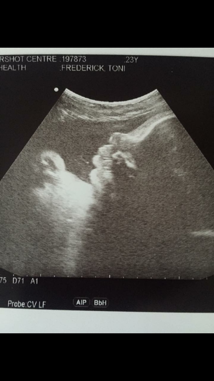 Had this scan at 38 weeks and first thing I noticed was his nose and ...