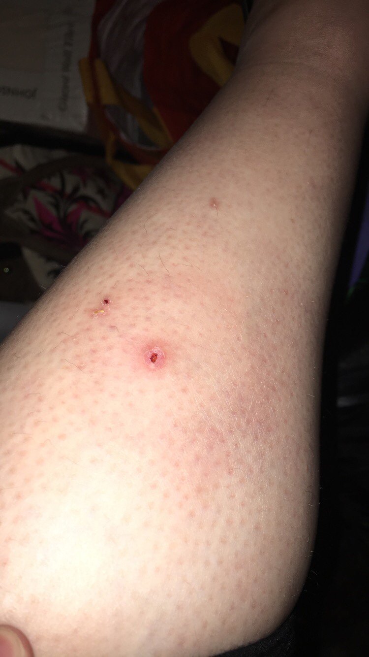 Very strange reaction to bite?!?