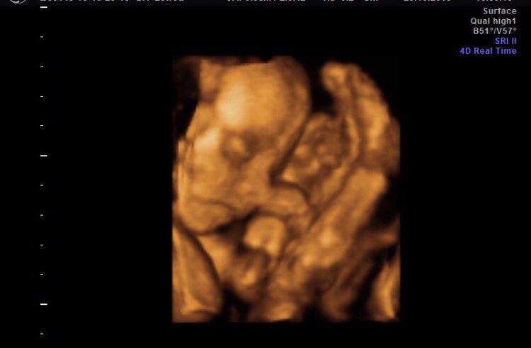 24 Weeks 4d Ultrasound