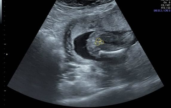 Gender at 17 weeks 2 days