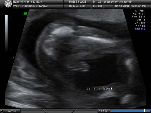 Gender at 17 weeks 2 days