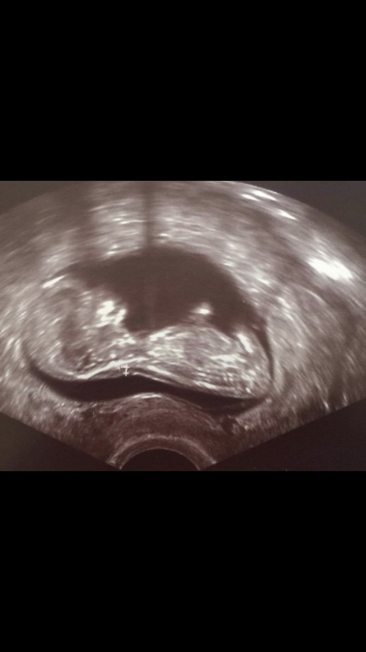 Help! Can you guess the gender (12 week scan)