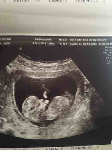 Help! Can you guess the gender (12 week scan)