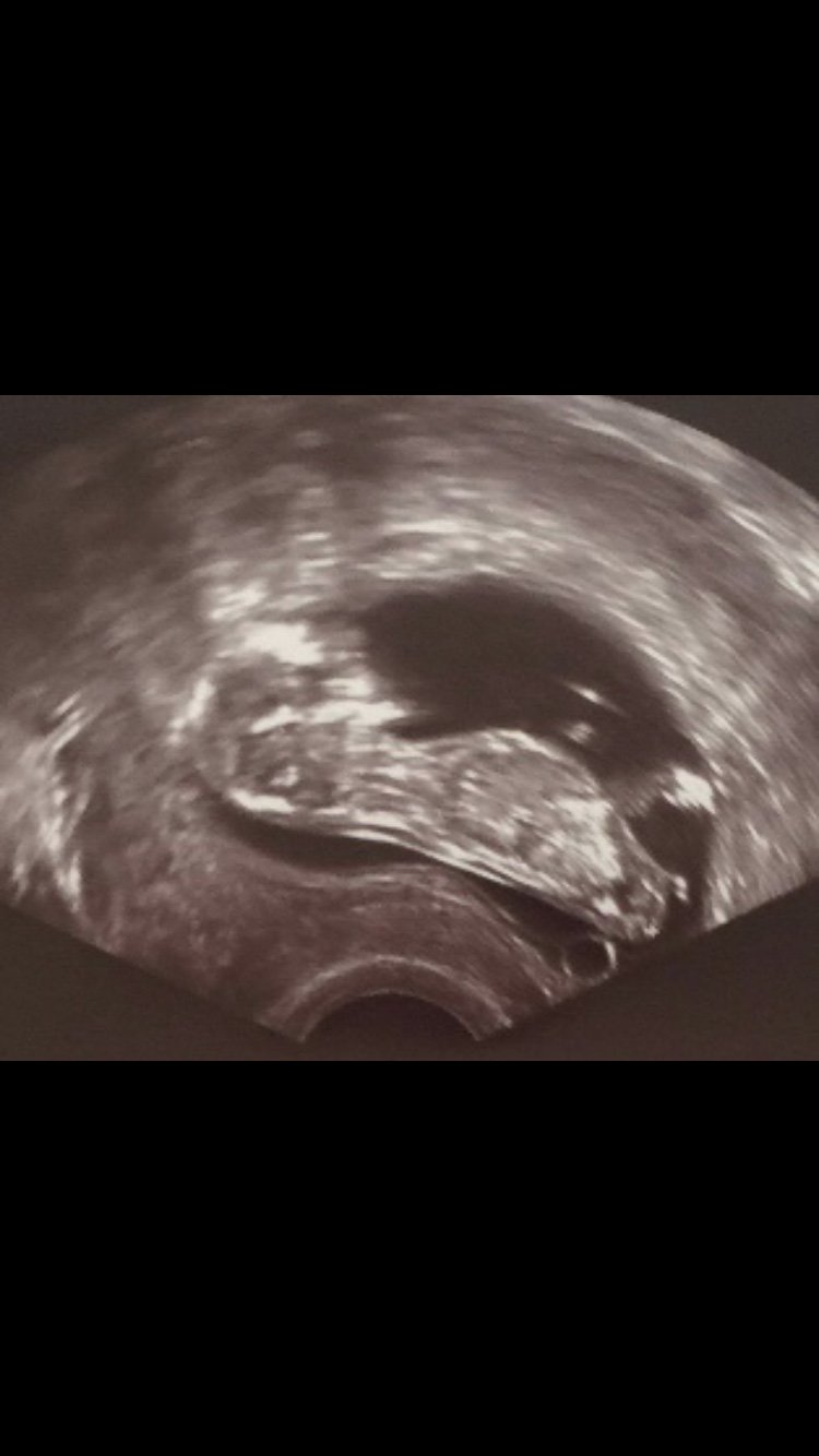 Help! Can you guess the gender (12 week scan)