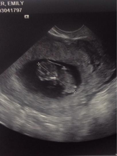 Nub on 10 week scan?!