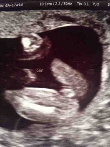 16 Week Gender Scan Boy Or Girl