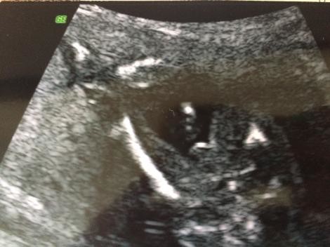 16 Week Gender Scan Boy Or Girl