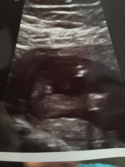 16 Week Gender Scan Boy Or Girl