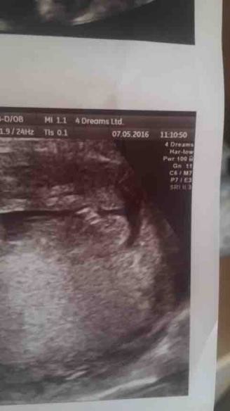 16 Week Gender Scan Boy Or Girl