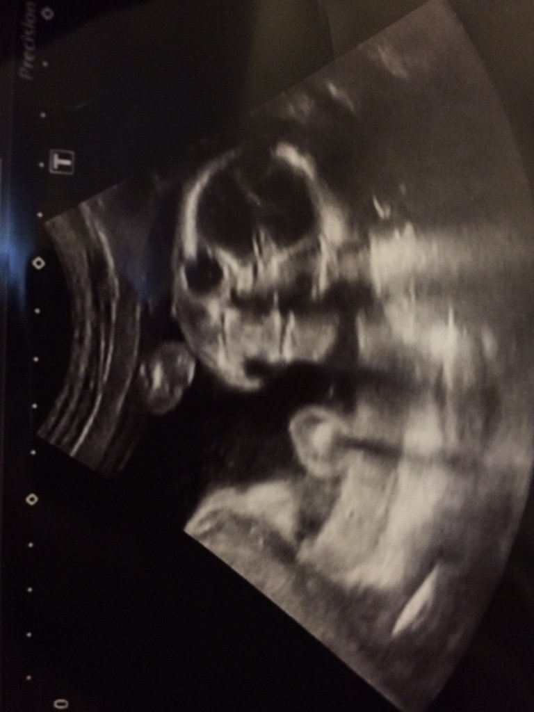 Post your clear forward facing 12weeks scans!!