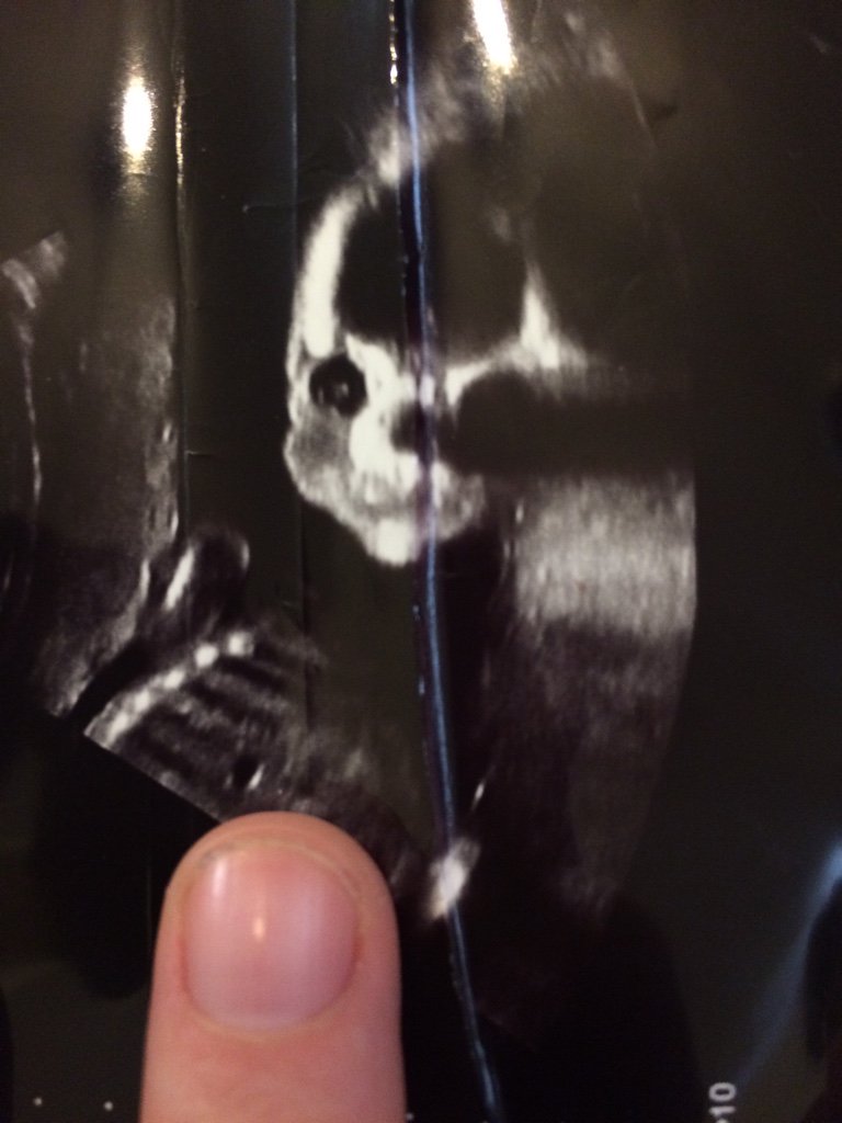 Post your clear forward facing 12weeks scans!!