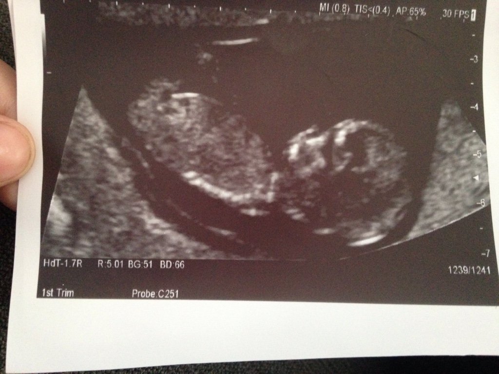 Post your clear forward facing 12weeks scans!!