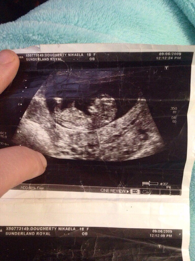 Post your clear forward facing 12weeks scans!!