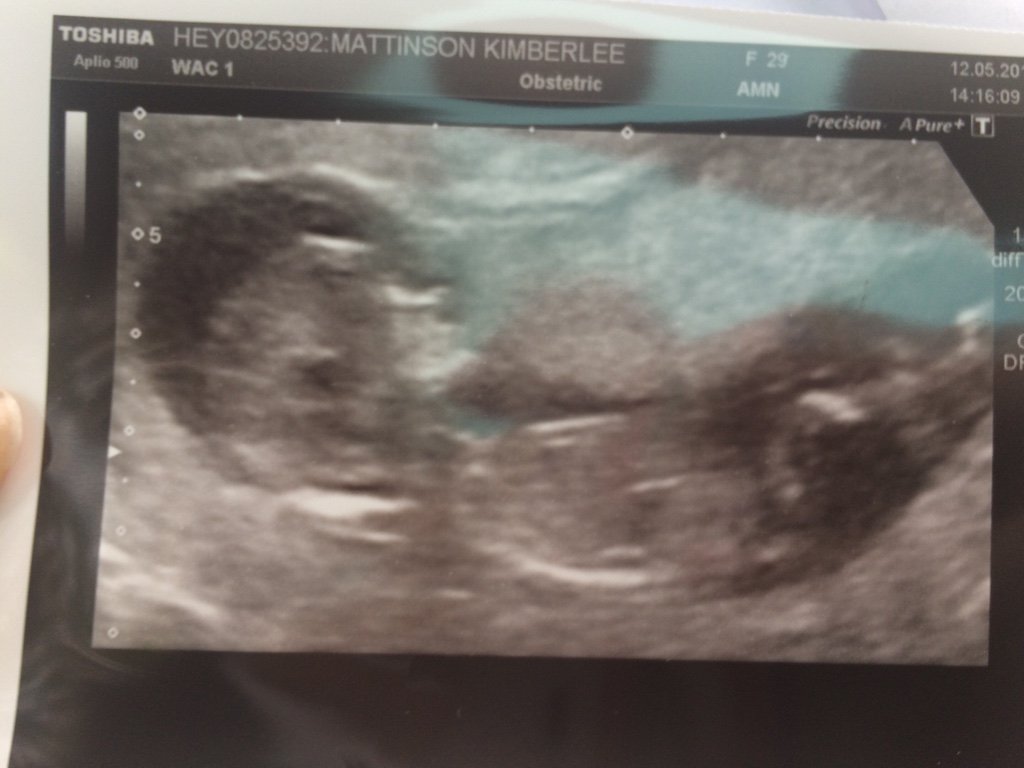 13 week baby scan pictures. Guess the gender? Can I see your photos at ...