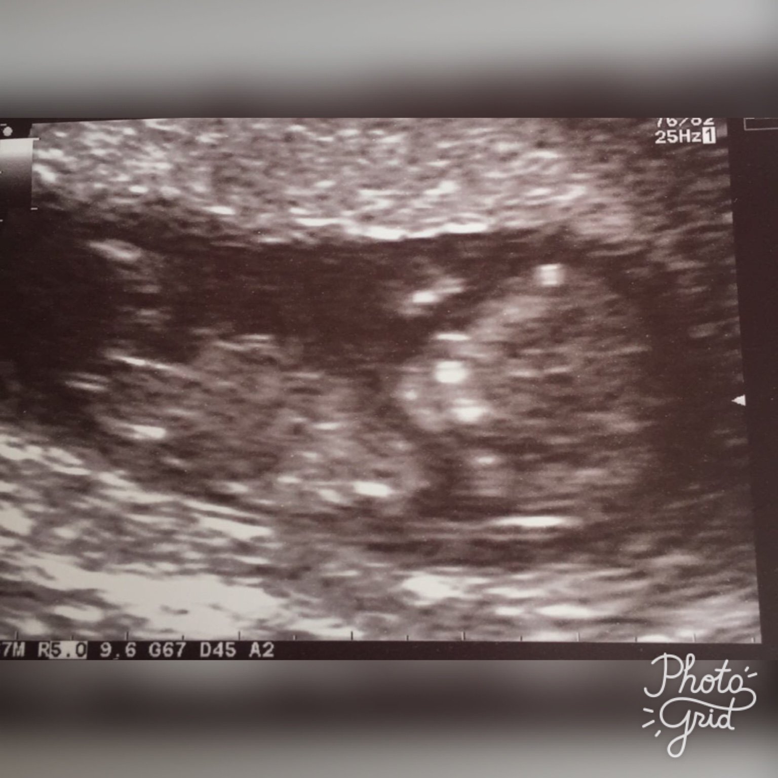 13 week baby scan pictures. Guess the gender? Can I see your photos at ...