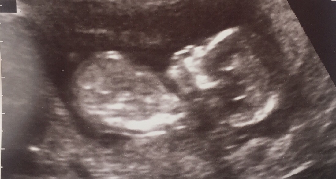 13 week baby scan pictures. Guess the gender? Can I see your photos at ...