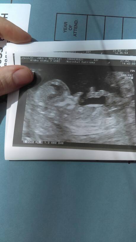 13 week baby scan pictures. Guess the gender? Can I see your photos at ...