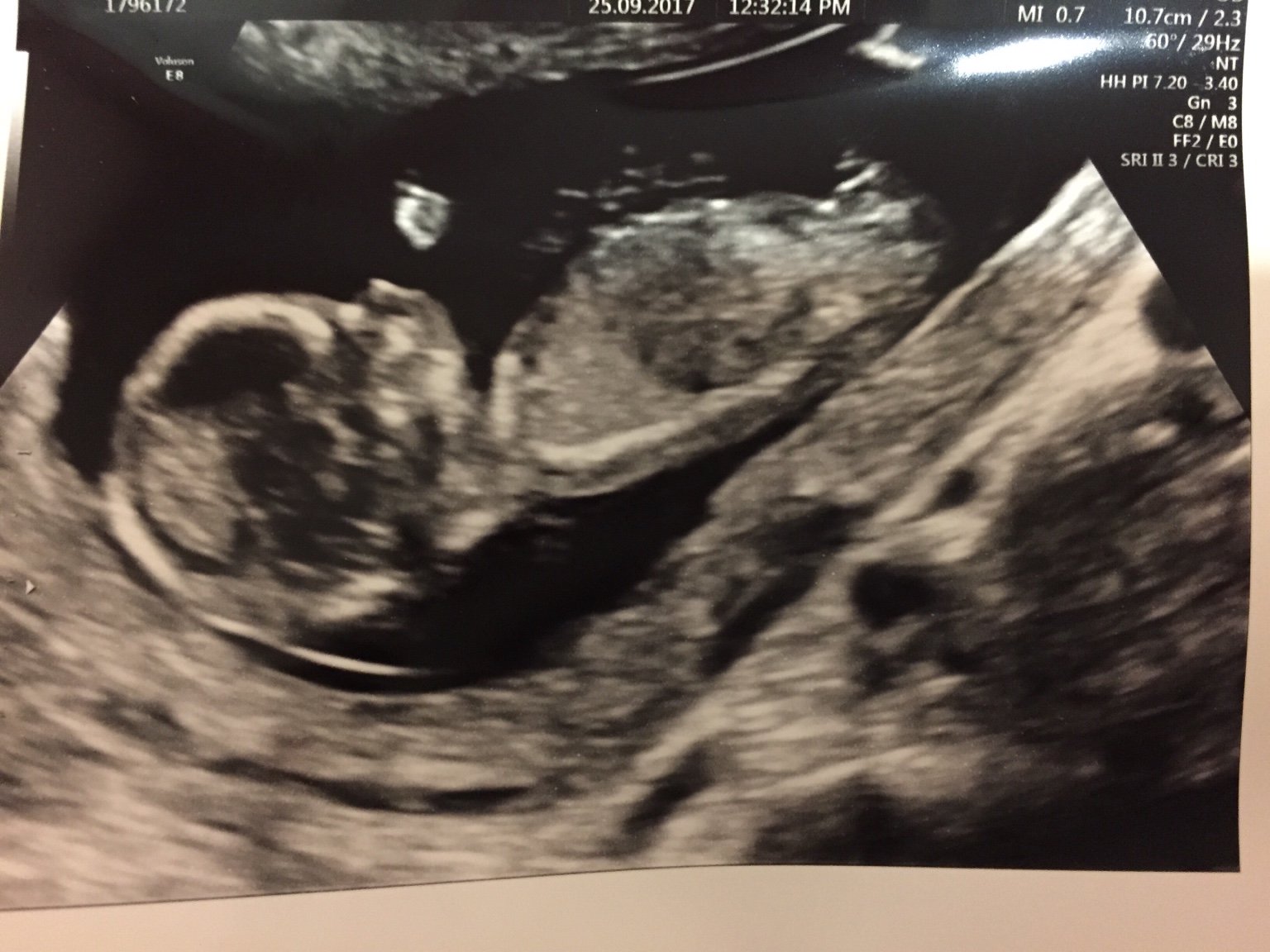 Early scan at 9 weeks 6 days. Girl/boy?