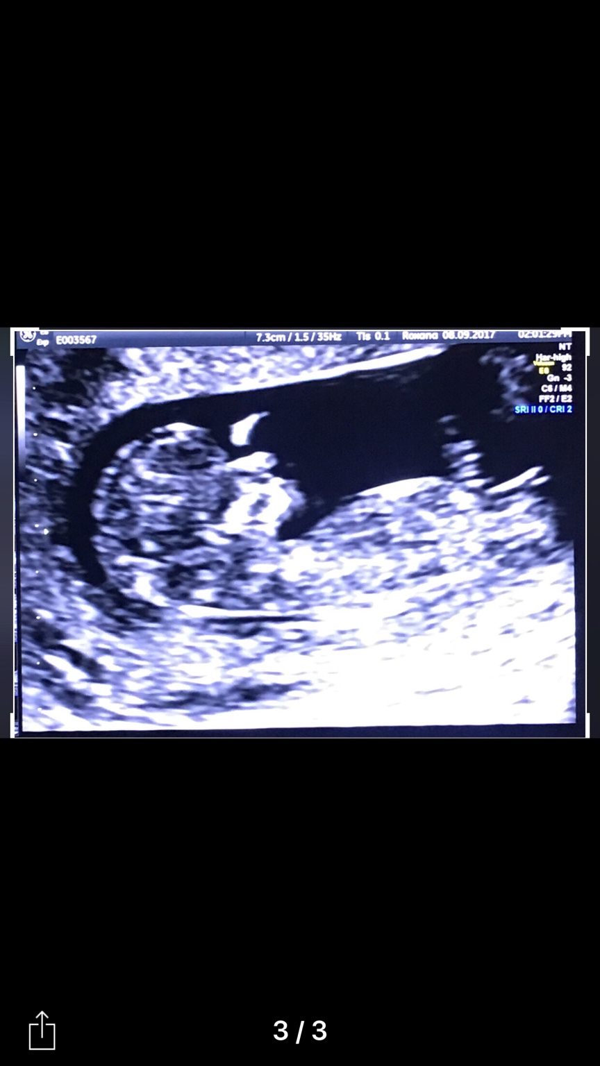 Early scan at 9 weeks 6 days. Girl/boy?