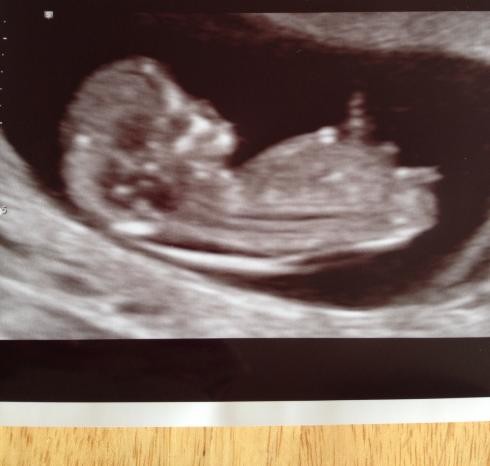 Concerned about appearance of nuchal fold on 11 week scan