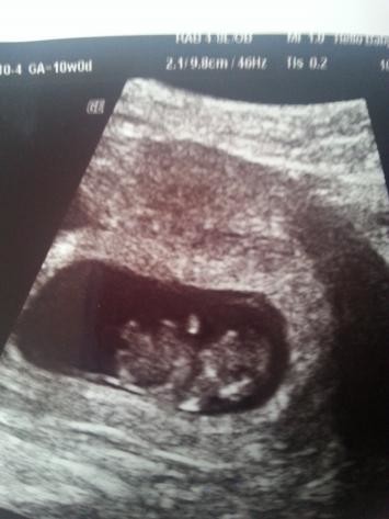Any 9 week scan pictures?