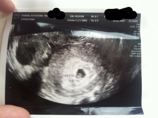 Anyone had a scan at 5 weeks?