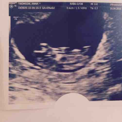 10 Week Scan.......any pictures?