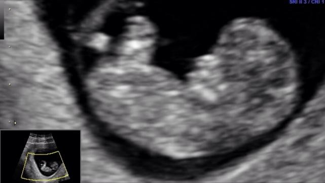 10 Week Scan.......any pictures?