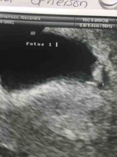 what can you see at 7 week scan