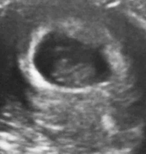 Early pregnancy scan tomorrow, 8.5-9.5 weeks pregnant - what to expect!!