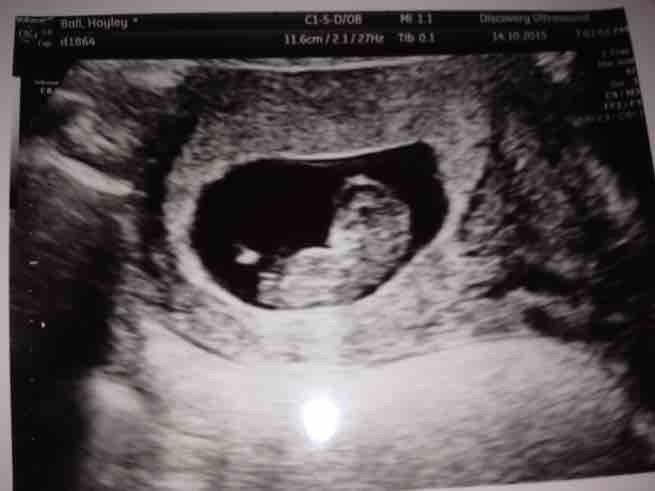 Early pregnancy scan tomorrow, 8.5-9.5 weeks pregnant - what to expect!!