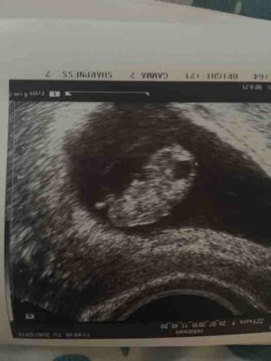 Early pregnancy scan tomorrow, 8.5-9.5 weeks pregnant - what to expect!!