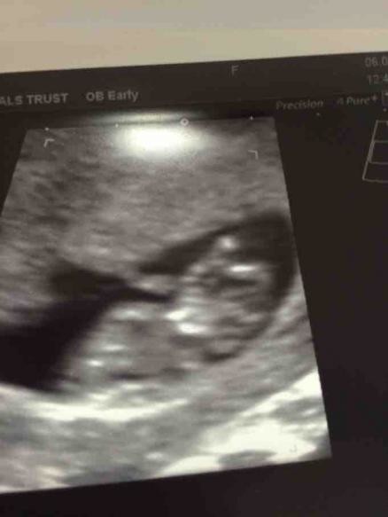 Early Scan Photos Post! - Page: 4