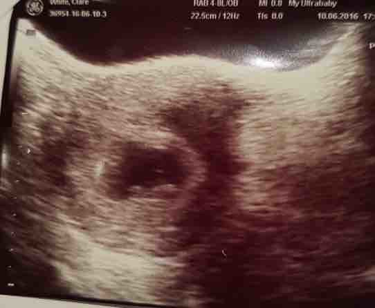 Show me a 7 week scan pic please