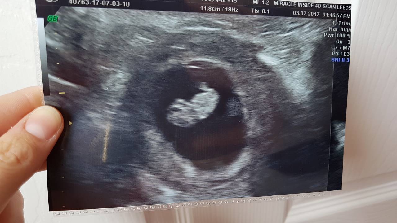 8 Weeks Scans - Can i see your pictures please