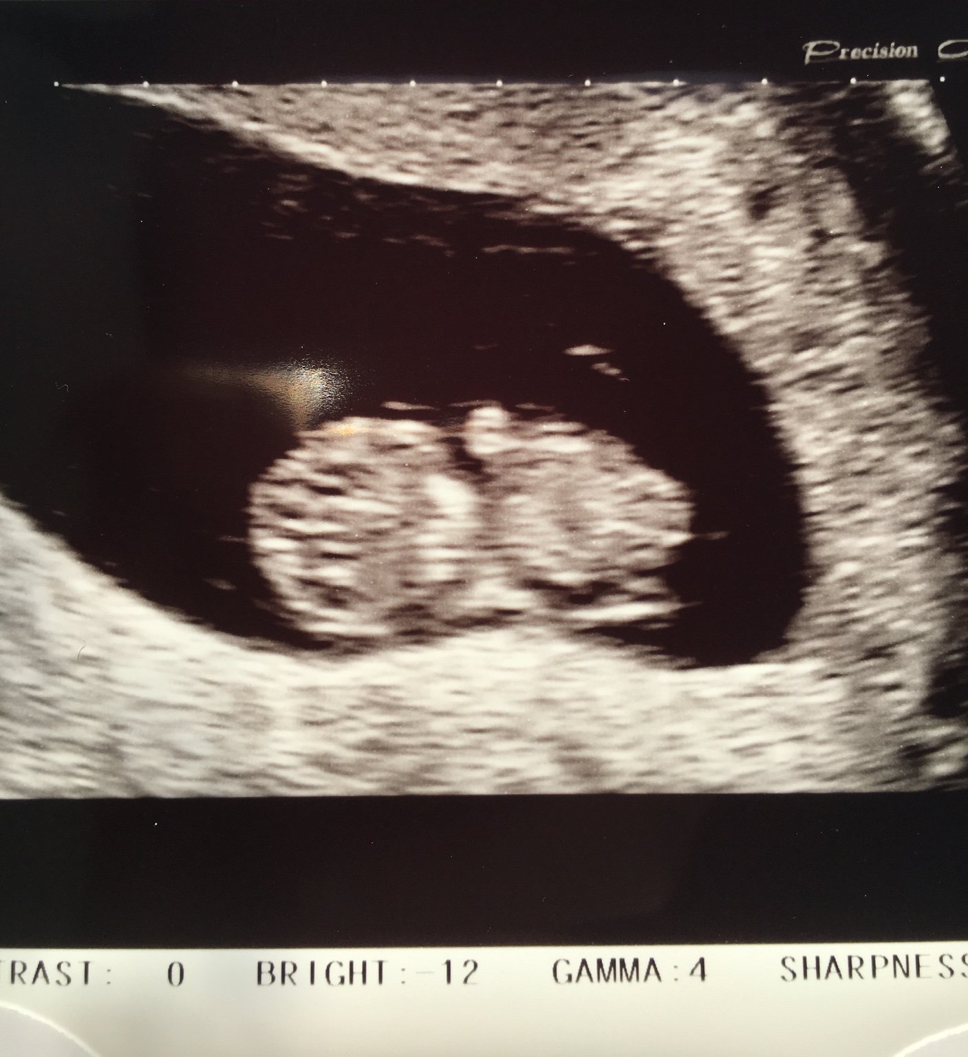 8 Weeks Scans - Can i see your pictures please