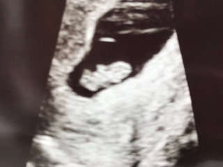 8 Weeks Scans - Can i see your pictures please