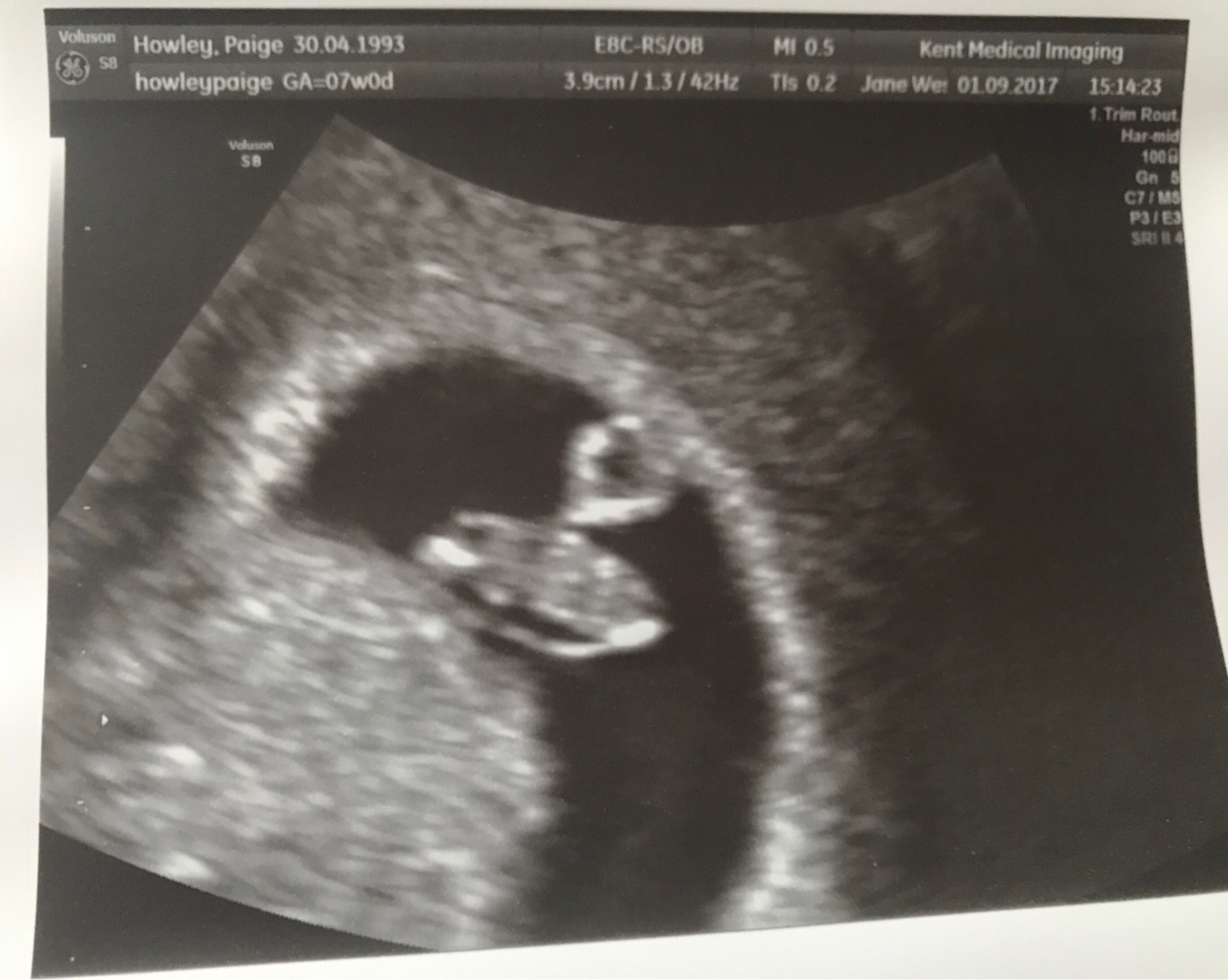 What does an early scan look like at 6 weeks and can you hear a ...