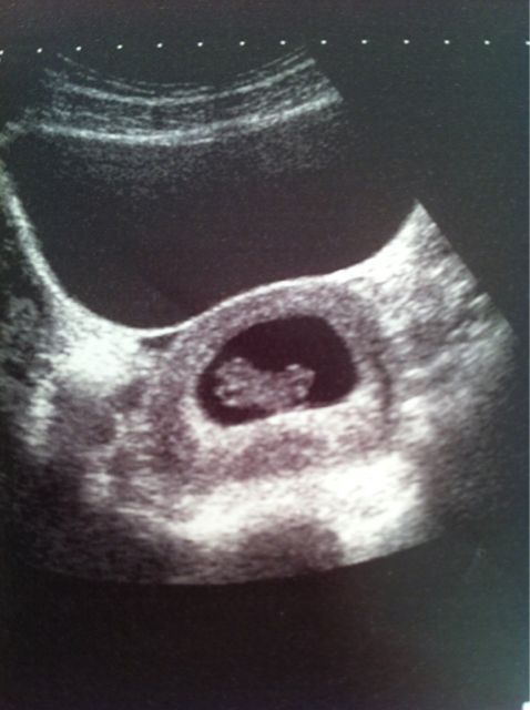 9 weeks scan?