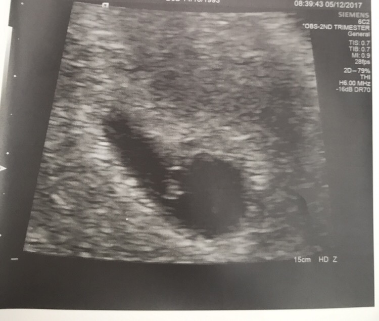 9 weeks scan?