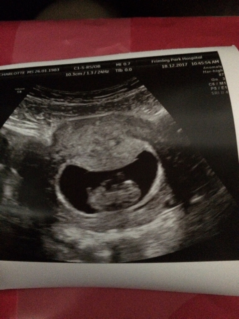 9 weeks scan?