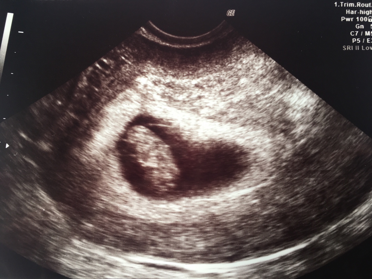 9 weeks scan?