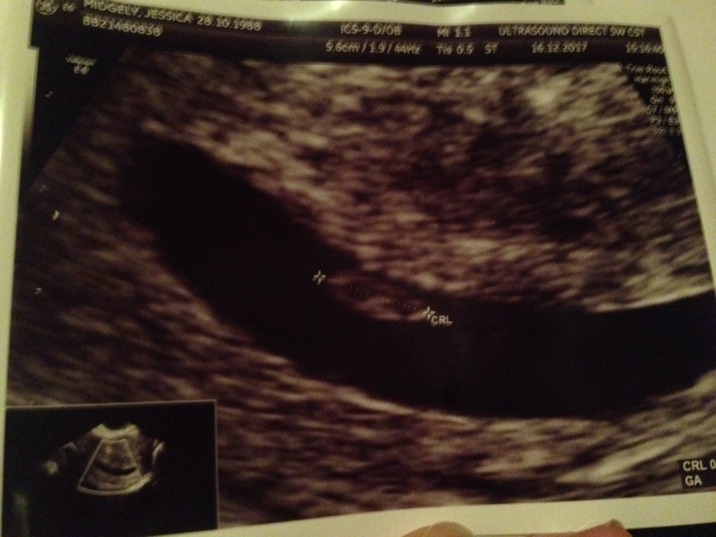 Early scan tomorrow. What can i expect?